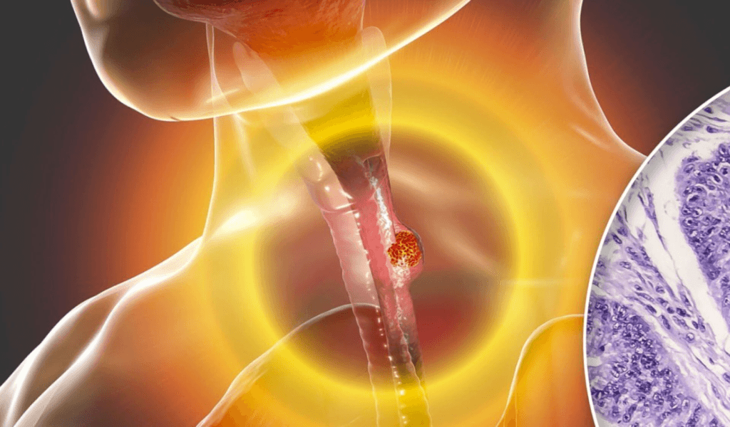 Todo lo que deberías saber sobre el cáncer de cabeza y cuello – De ...
